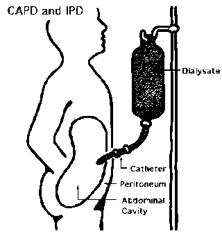 Peritoneal Dialysis