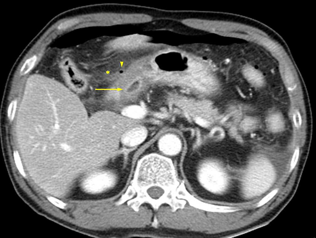 Ulcere gastroduodenal
