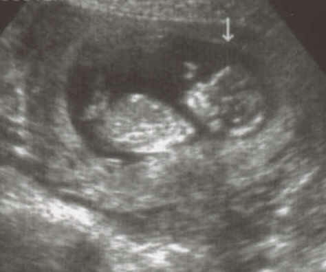 Ashlyn Ultrasound Pics