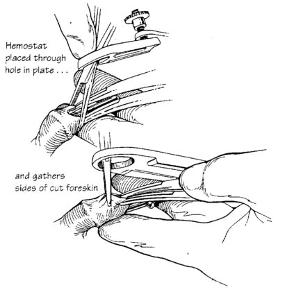 In order to apply the clamp the foreskin isgrabbed with hemostats as ...