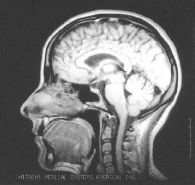MRI of Head (Profile)