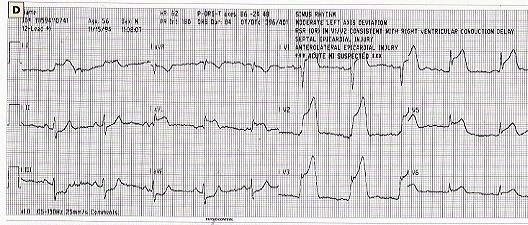 Field 12 Lead ECG Diagnosis