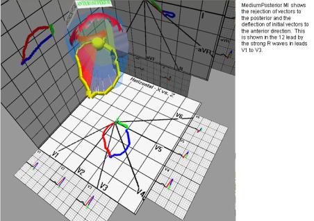 THE ECG IN 3D HEART TO LOOP TO LEADS