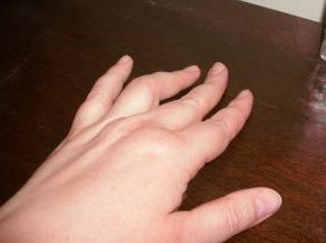 Arthritis ~ How it changed my life