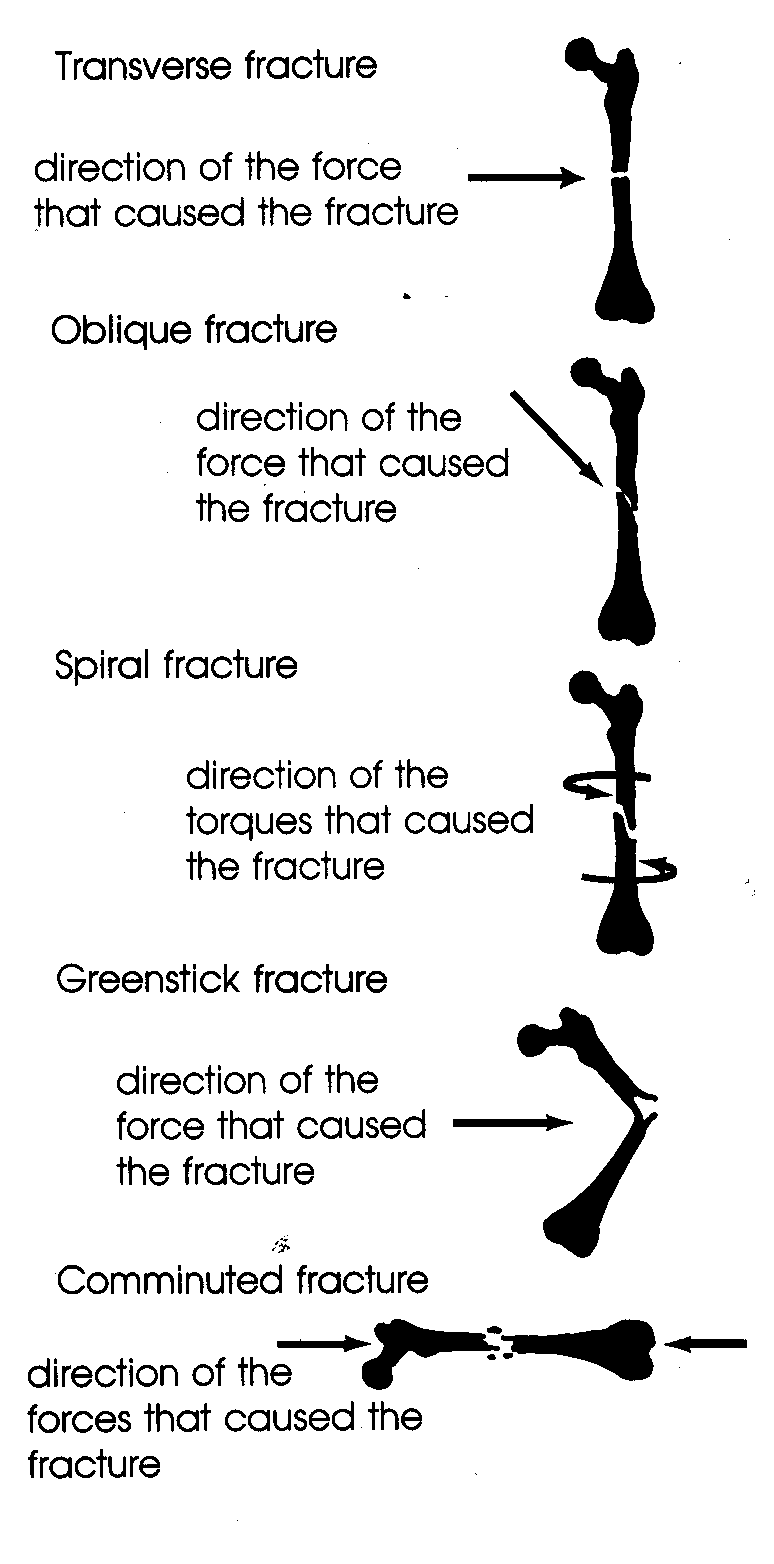 Types of Fractures: